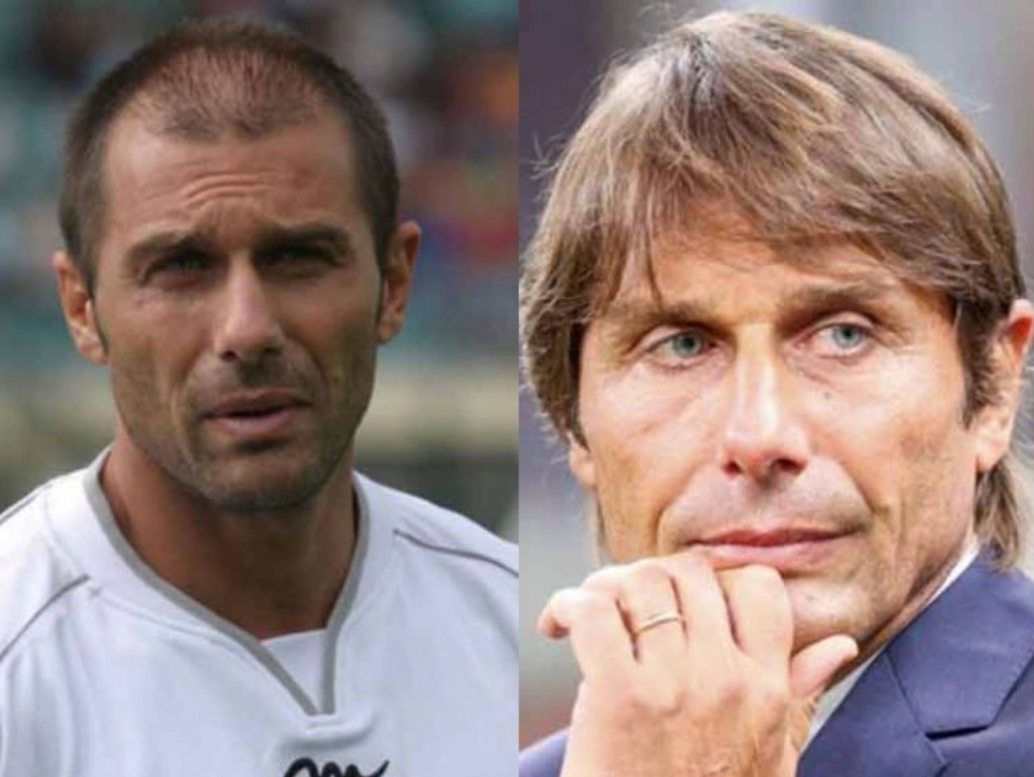 - Athlètes célèbres avec greffe de cheveux